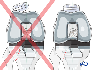 Complete tibial revision with varus/valgus CCK system for Fracture ...
