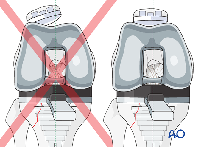 Complete tibial revision with varus/valgus CCK system for Fracture ...