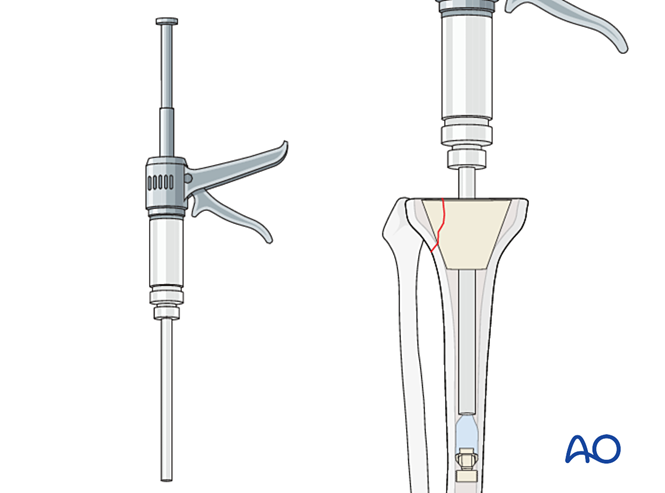 Complete tibial revision with varus/valgus CCK system for Fracture ...