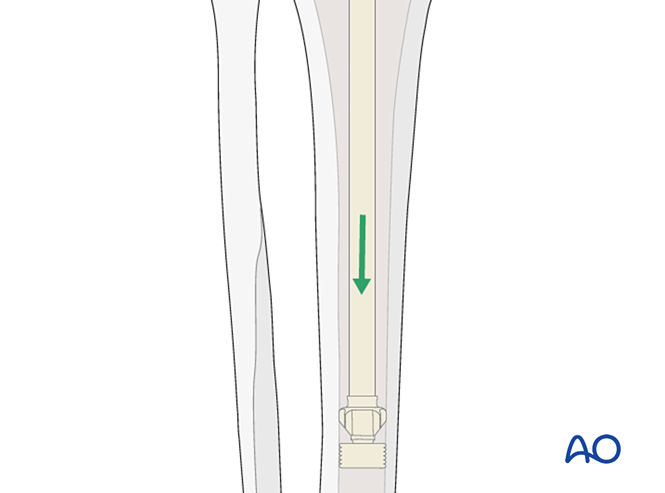 Complete tibial revision with varus/valgus CCK system for Fracture ...