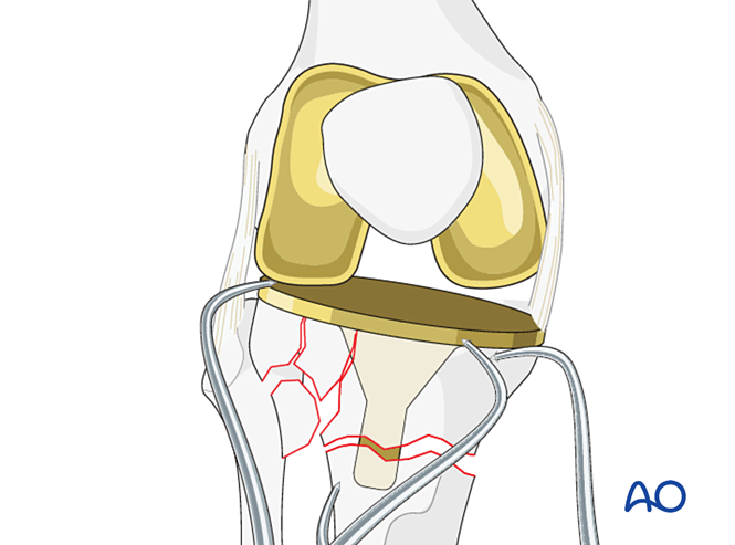 Complete tibial revision with hinged knee for Fracture around a loose ...