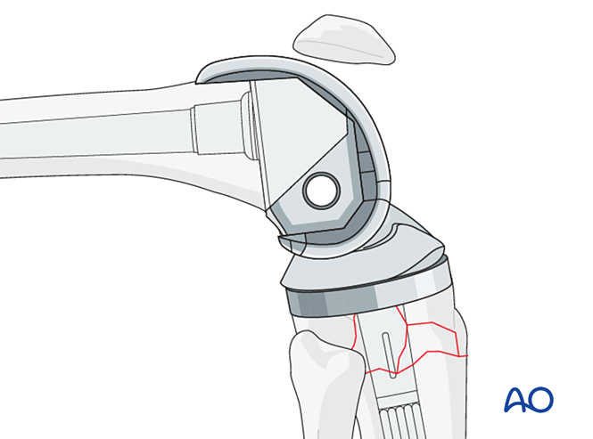 Complete tibial revision with hinged knee for Fracture around a loose ...