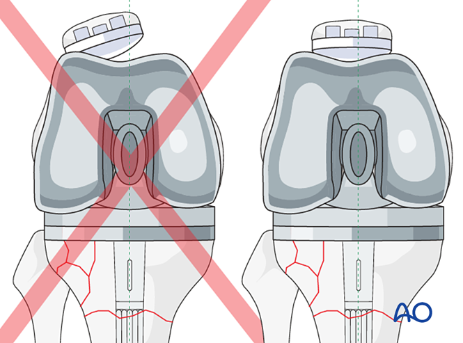 Complete tibial revision with hinged knee for Fracture around a loose ...