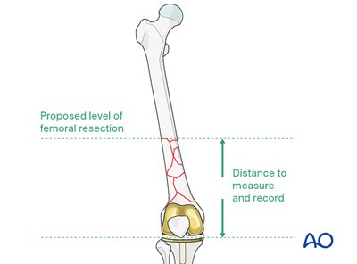 Distal femoral replacement for Fracture around a loose femoral ...
