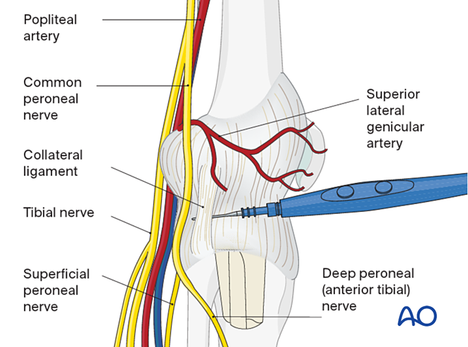 Distal femoral replacement for Fracture around a loose femoral ...
