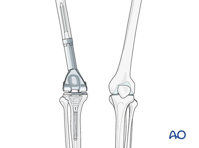 Distal femoral replacement for Fracture around a loose femoral ...
