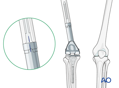 Distal femoral replacement for Fracture around a loose femoral ...
