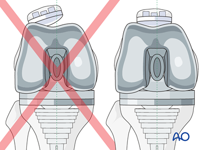 Distal femoral replacement for Fracture around a loose femoral ...