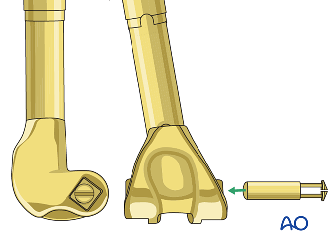 Distal femoral replacement for Fracture around a loose femoral ...