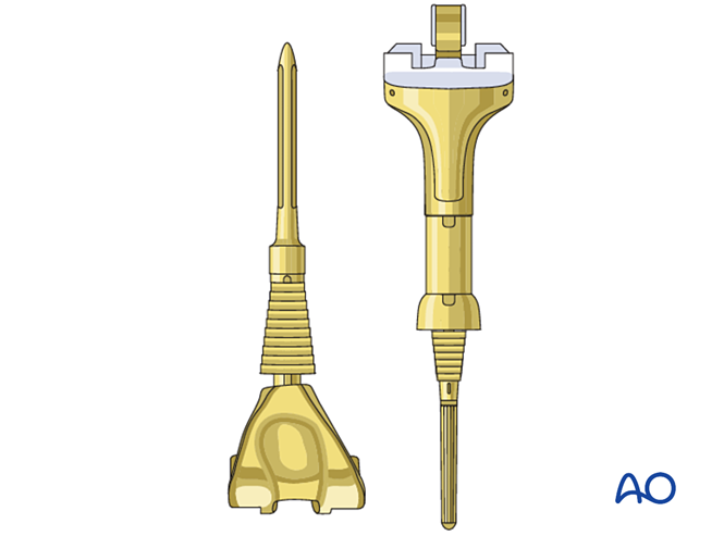 Proximal tibia replacement for Fracture around a loose tibial component ...