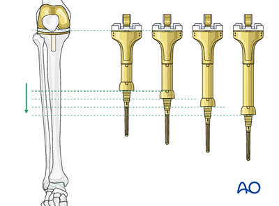 Proximal tibia replacement for Fracture around a loose tibial component ...