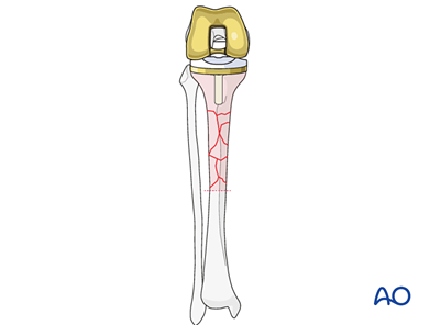 Proximal tibia replacement for Fracture around a loose tibial component ...