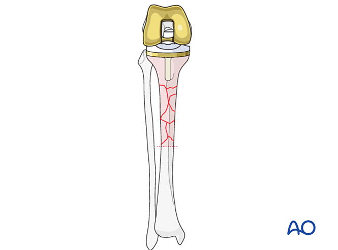Proximal tibia replacement for Fracture around a loose tibial component ...