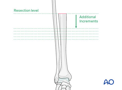 Proximal tibia replacement for Fracture around a loose tibial component ...