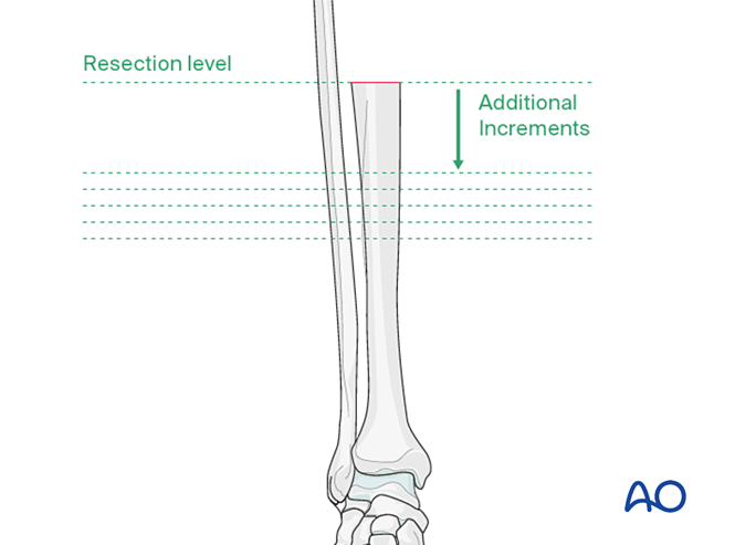Proximal tibia replacement for Fracture around a loose tibial component ...