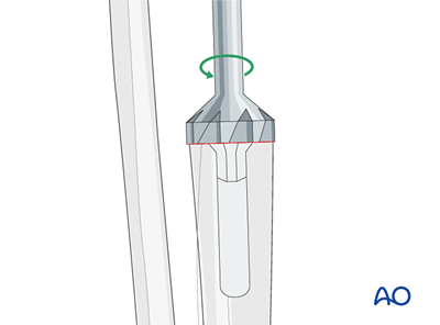Proximal tibia replacement for Fracture around a loose tibial component ...