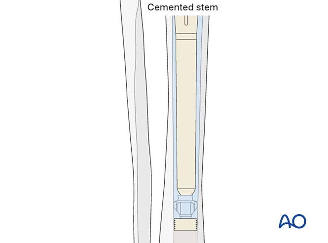 Proximal tibia replacement for Fracture around a loose tibial component ...