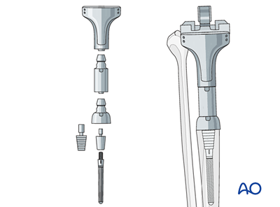 Proximal tibia replacement for Fracture around a loose tibial component ...