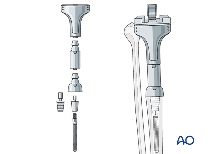 Proximal tibia replacement for Fracture around a loose tibial component ...