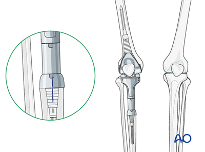 Proximal tibia replacement for Fracture around a loose tibial component ...