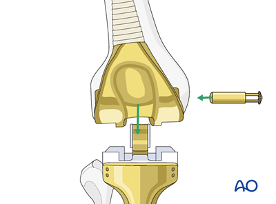Proximal tibia replacement for Fracture around a loose tibial component ...