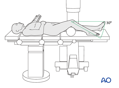 Supine position with knee flexed 30°