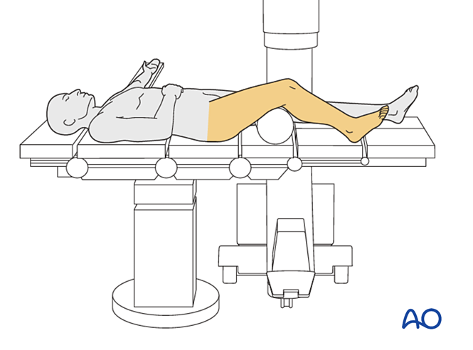 Supine position with knee flexed 30°