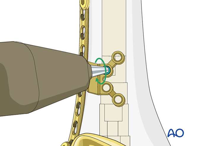 Adjunct plate options