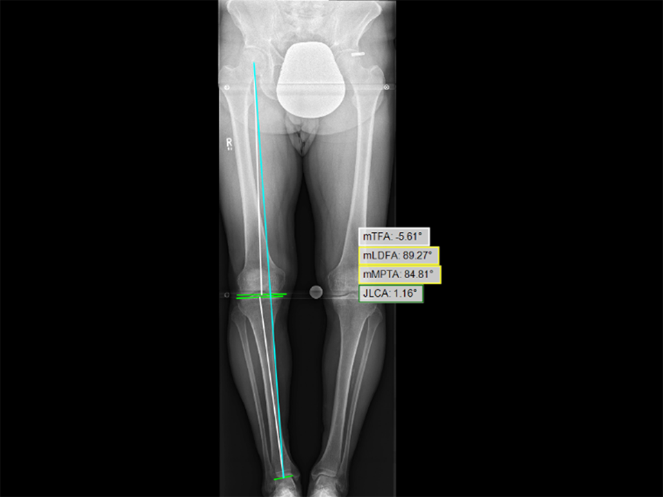 Automated Deformity Analysis and Osteotomy Planning Tool in the Coronal ...