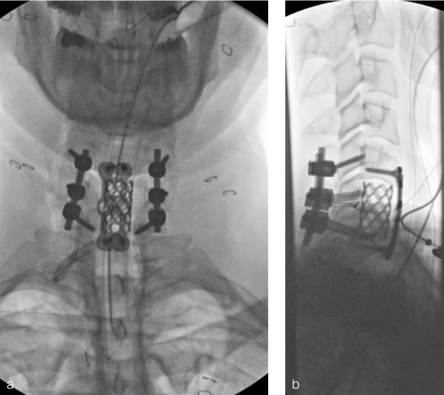 CODA™ Anterior Cervical Plate System