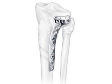 LCP Proximal Tibia Plate 4.5