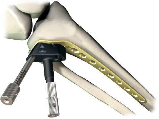 LCP Proximal Lateral Tibia