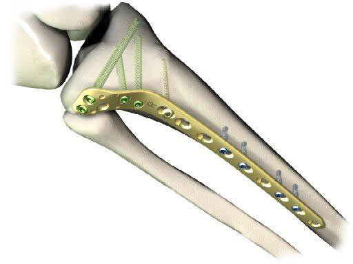 LCP Proximal Lateral Tibia