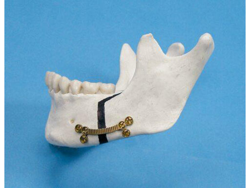 2.0 mm Ti Curved Sagittal Split Plate, 6-hole