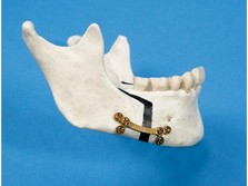 2.0 mm Ti Curved Sagittal Split Plate, 6-hole