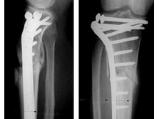 LISS Proximal Lateral Tibia: Study Results