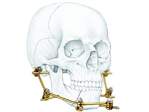 Mandible External Fixation Set