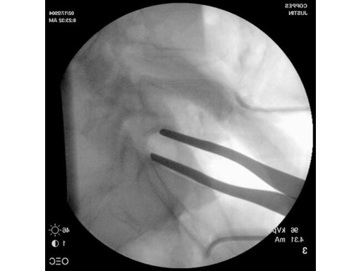 SynFrame / Standard Access Radiolucent Retractor Blades