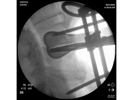 SynFrame / Standard Access Radiolucent Retractor Blades