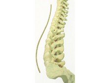 Pre-Contoured Scoliosis Rods