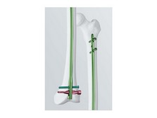 Distal Femoral Nail with Spiral Blade
