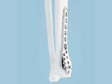 LCP Distal Tibia Plate