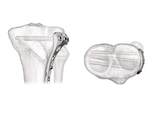 LCP Proximal Tibia Plate 4.5