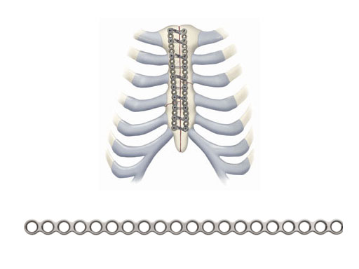 Modular Sternal Cable System