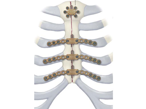 Sternum Plating System