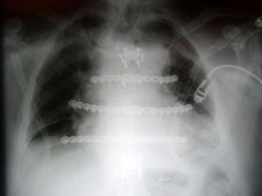 Sternum Plating System