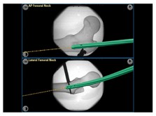Axis Reduction and Alignment Module