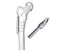 Dynamic Hip Screw (DHS) Blade
