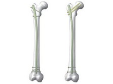 Expert Lateral Femoral Nail (LFN)