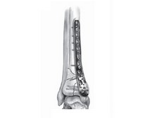 LCP Medial Distal Tibia Plate w/o tab 3.5